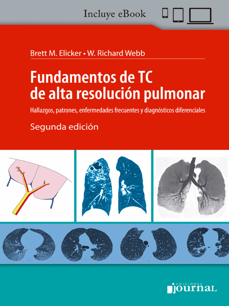 Elicker. Fundamentos de TC de Alta Resolución Pulmonar. 2a Ed. Journal. 2021 | PDF | Neumonía ...