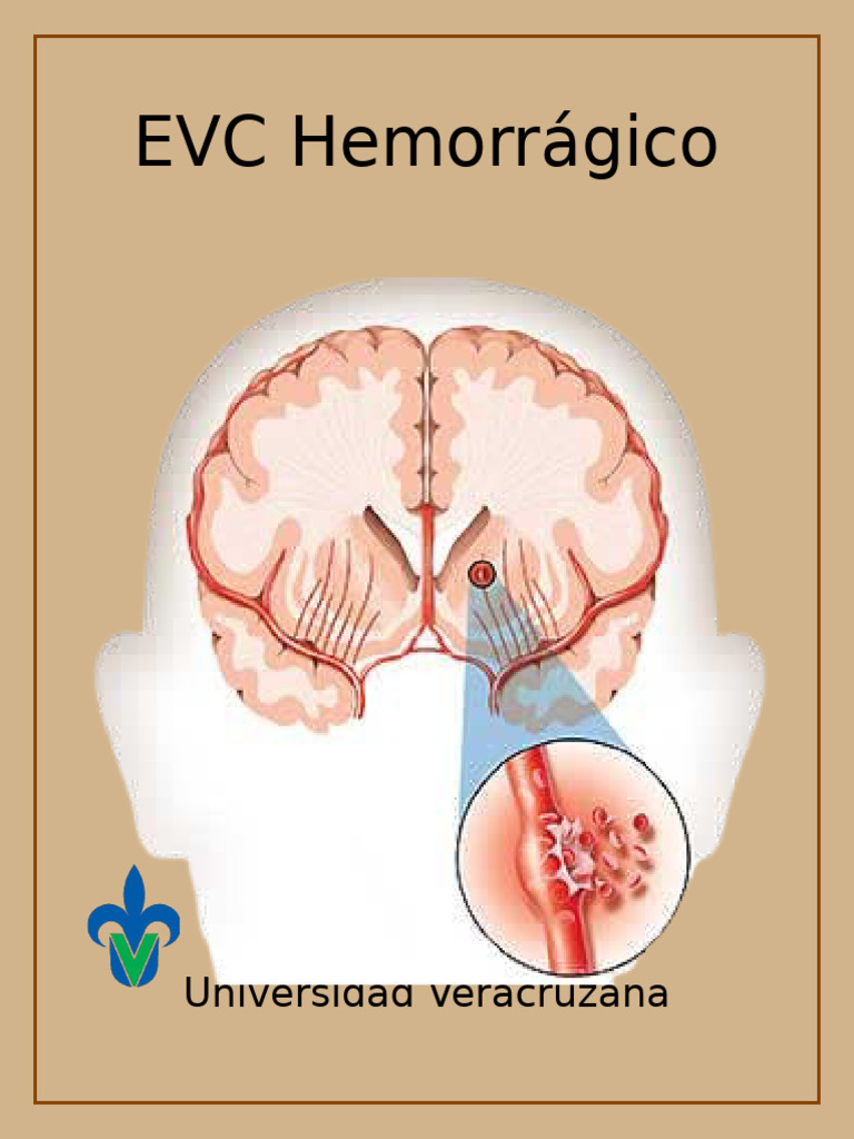 EVC Hemorrágico | PDF | Carrera | Isquemia