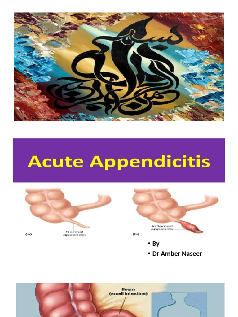 Acute Appendicitis by DR Amber Naseer | PDF