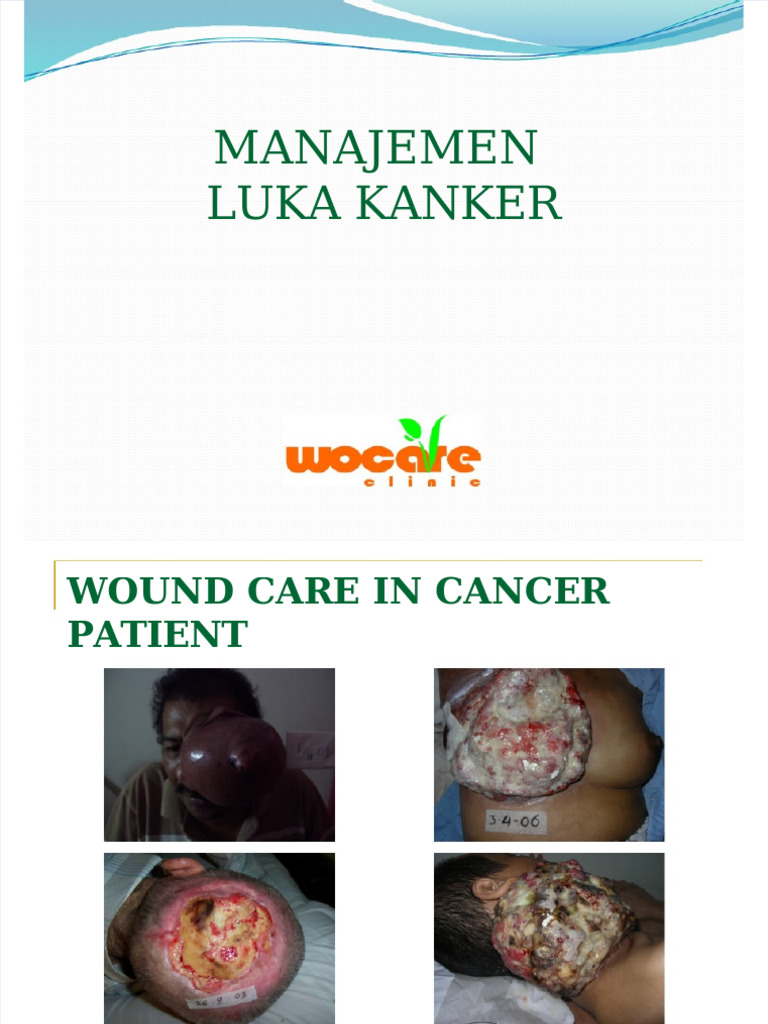 Manajemen Luka Kanker - Wocare | PDF