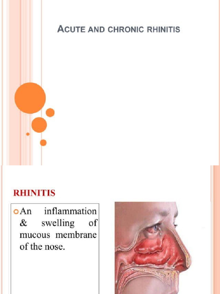 Acute & Chronic Rhinitis - PPTX - 20240423 - 125401 | PDF