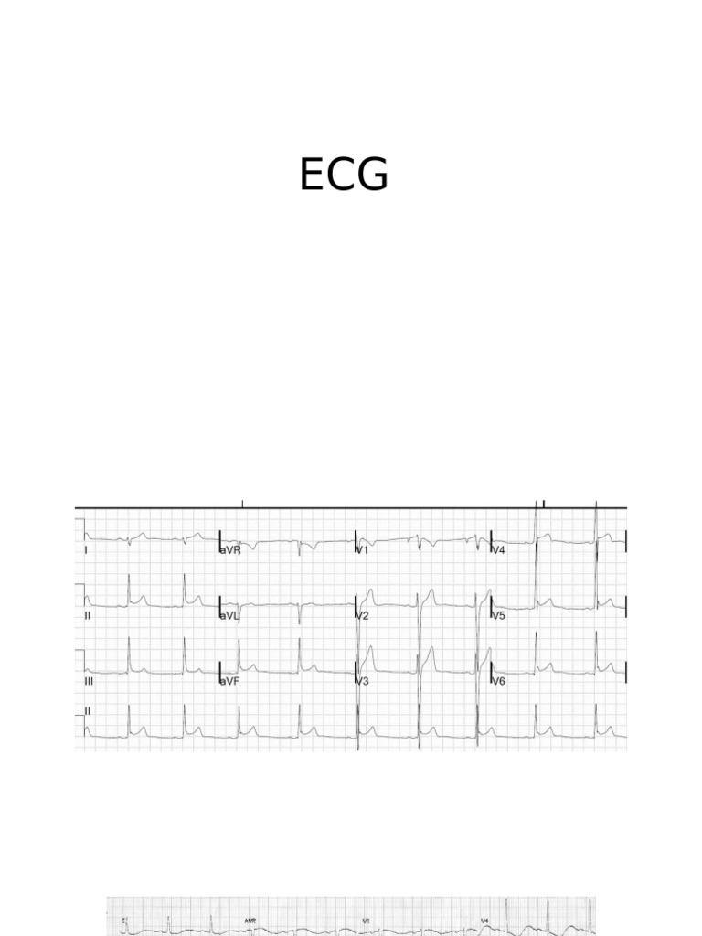 Ecg Exam | PDF