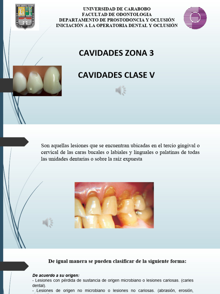Clasificación de Cavidades Clase V | PDF | Diente | Esmalte de dientes