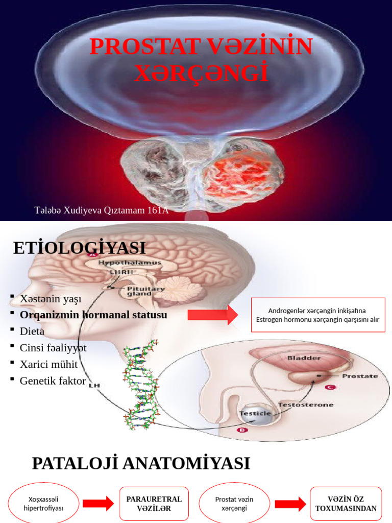 Prostat Xərçəngi | PDF