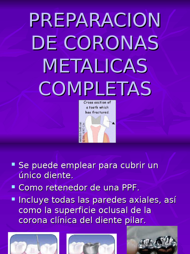 Preparación de Coronas Metálicas Dentales | PDF | Odontología | Diente