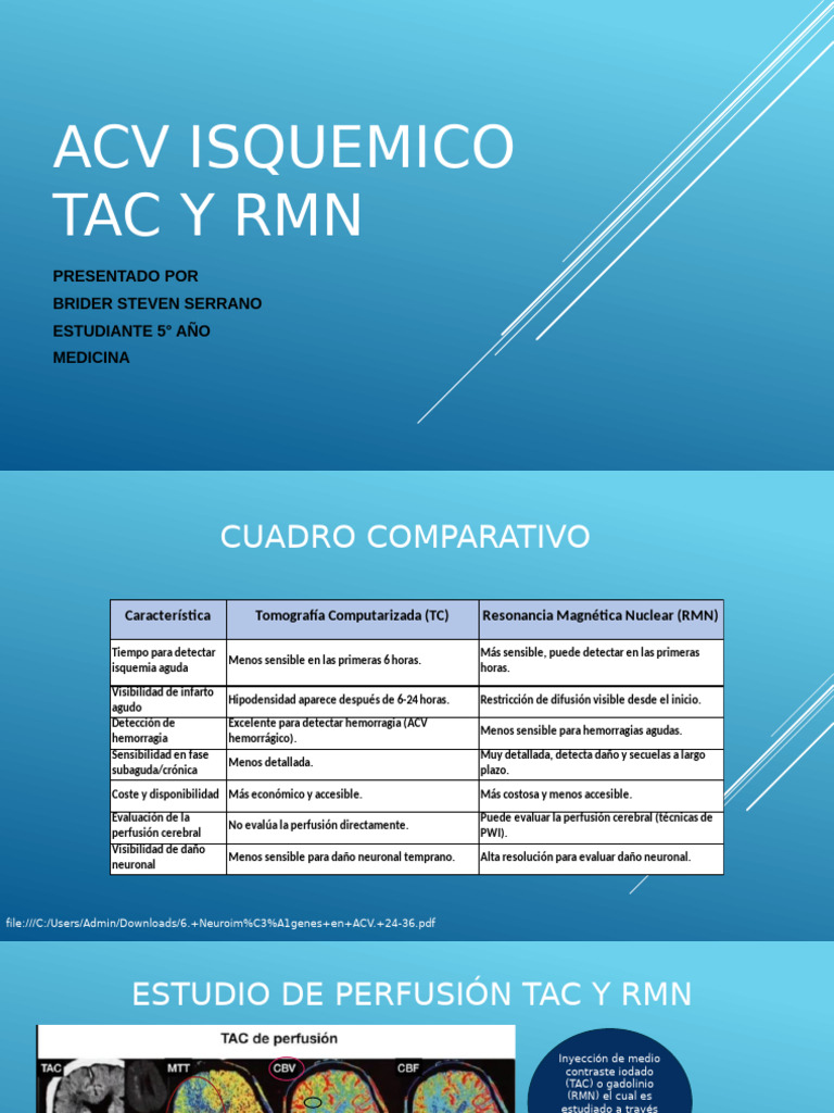 Acv Isquemico Tac y RMN 2 | PDF | Ct Scan | Carrera