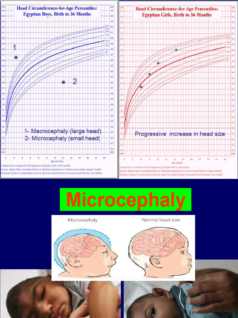 7 - Hydrocephalus-1 | PDF | Human Diseases And Disorders | Diseases And Disorders