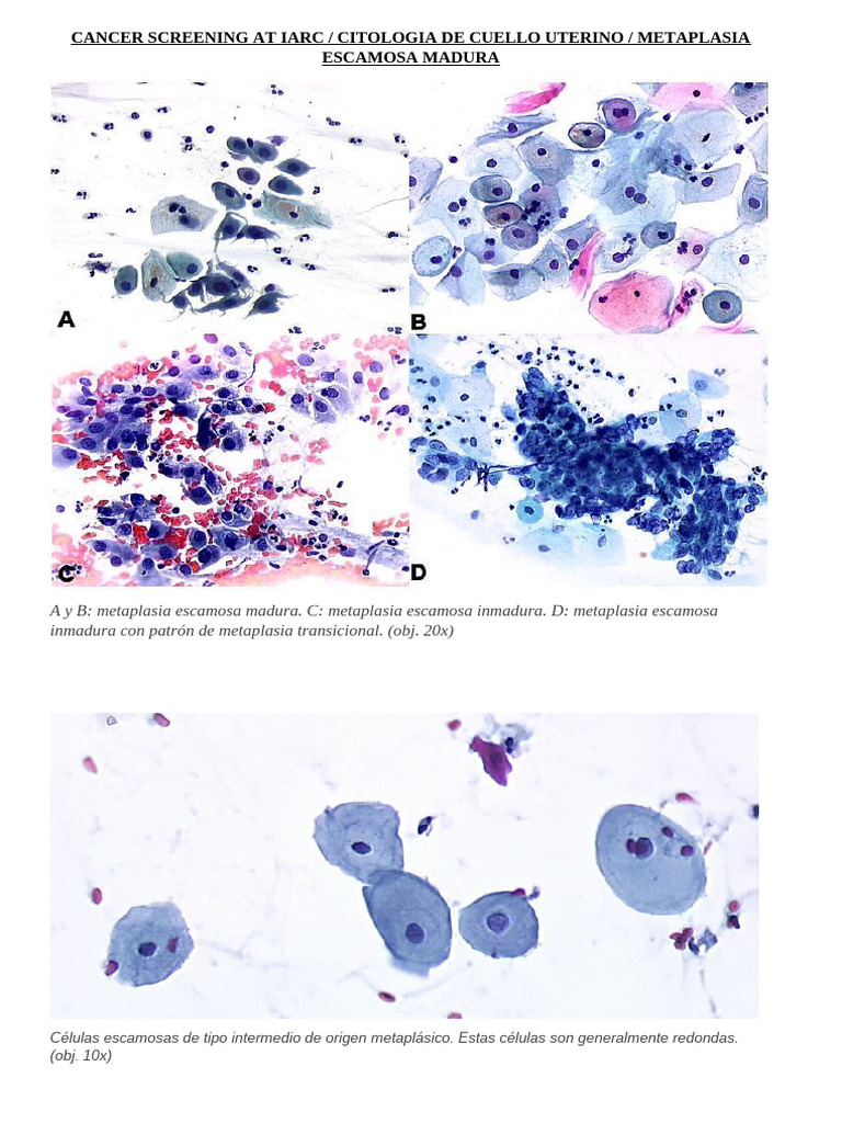 Metaplasia Escamosa en Citología Cervical | PDF | Citoplasma | Técnicas ...