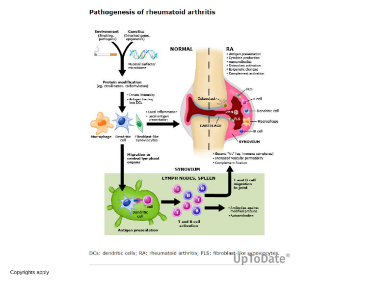 Pathogenesis of Rheumatoid Arthritis | PDF