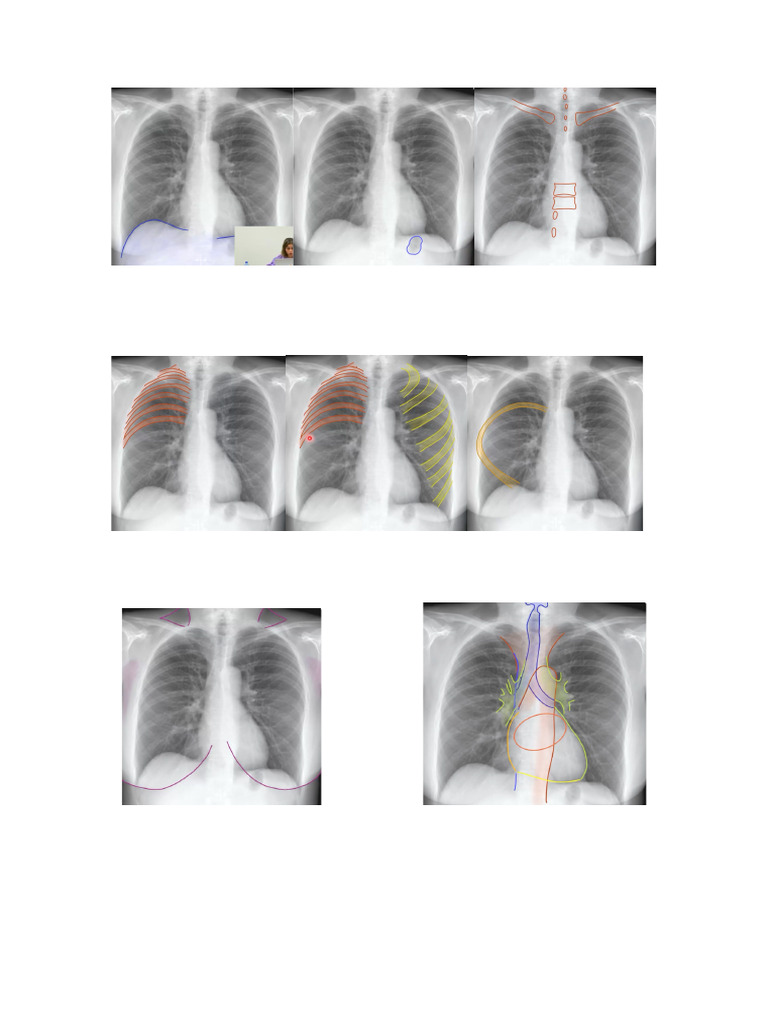 RX de Torax | PDF