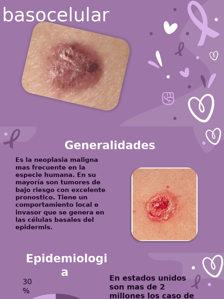 Cancer Basocelular | PDF