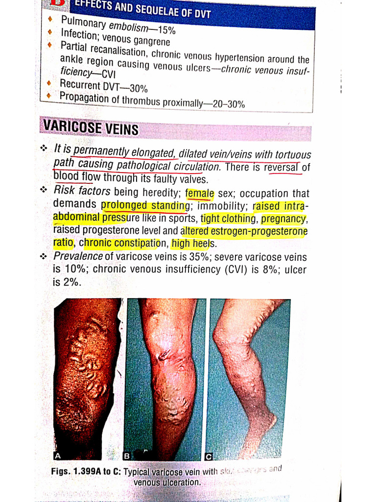 Varicose Veins | PDF