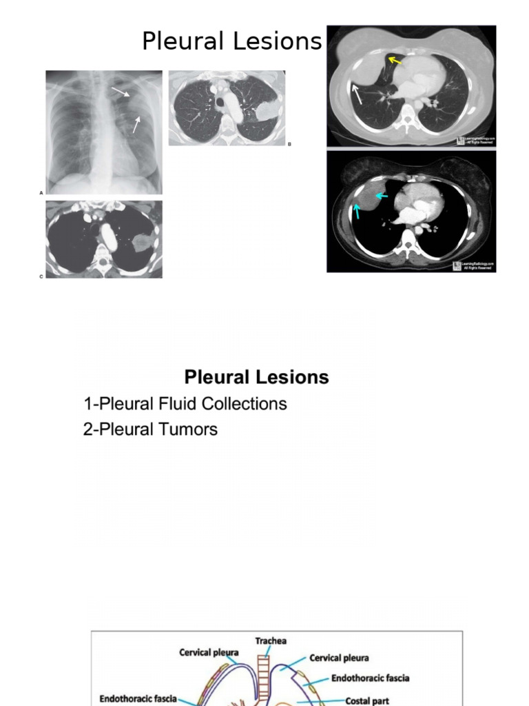 Pleural Lesions | PDF