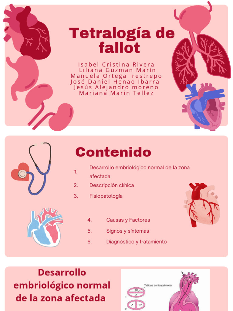 Tetralogia de Fallot | PDF | Corazón | Ventrículo (corazón)