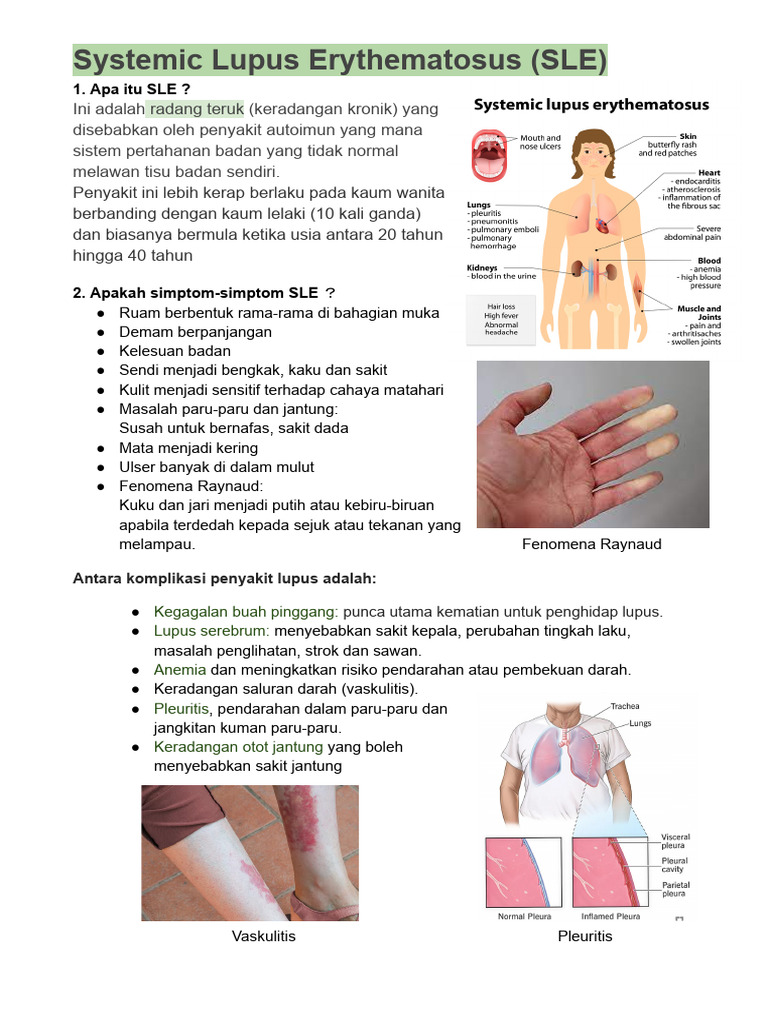 Systemic Lupus Erythematosus (SLE) | PDF