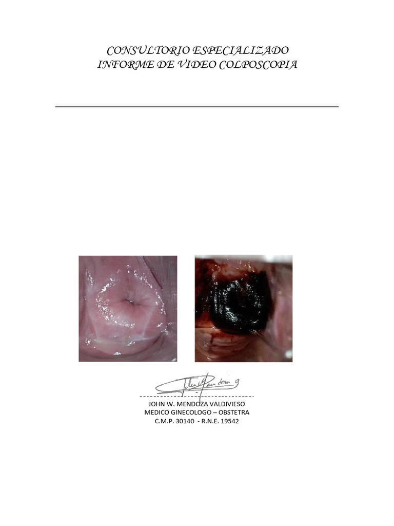 Colposcopia Nuñez Paulino Rina Isabel 01-05-24 | PDF
