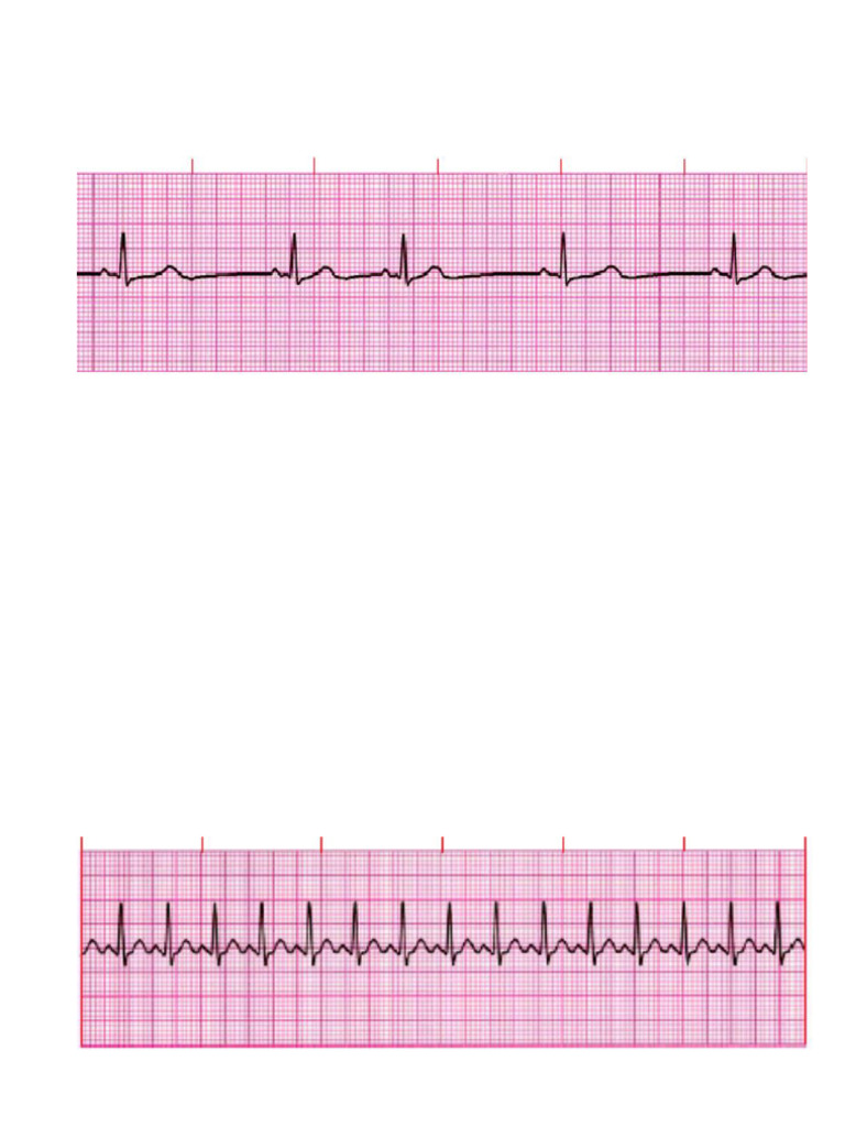 Ekg Osce | PDF