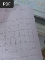 Understanding Delta Waves in ECG | PDF | Medical Specialties | Causes ...