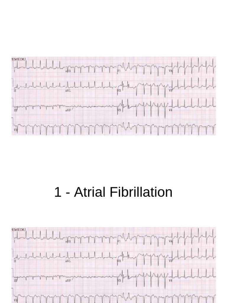 ECG Quiz: MCQs and Answers | PDF | Electrocardiography | Medical ...