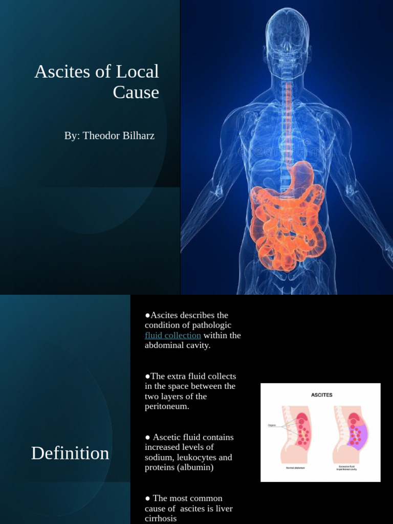 Ascites - of - Local - Cause 2 | PDF | Peritoneum | Medical Specialties