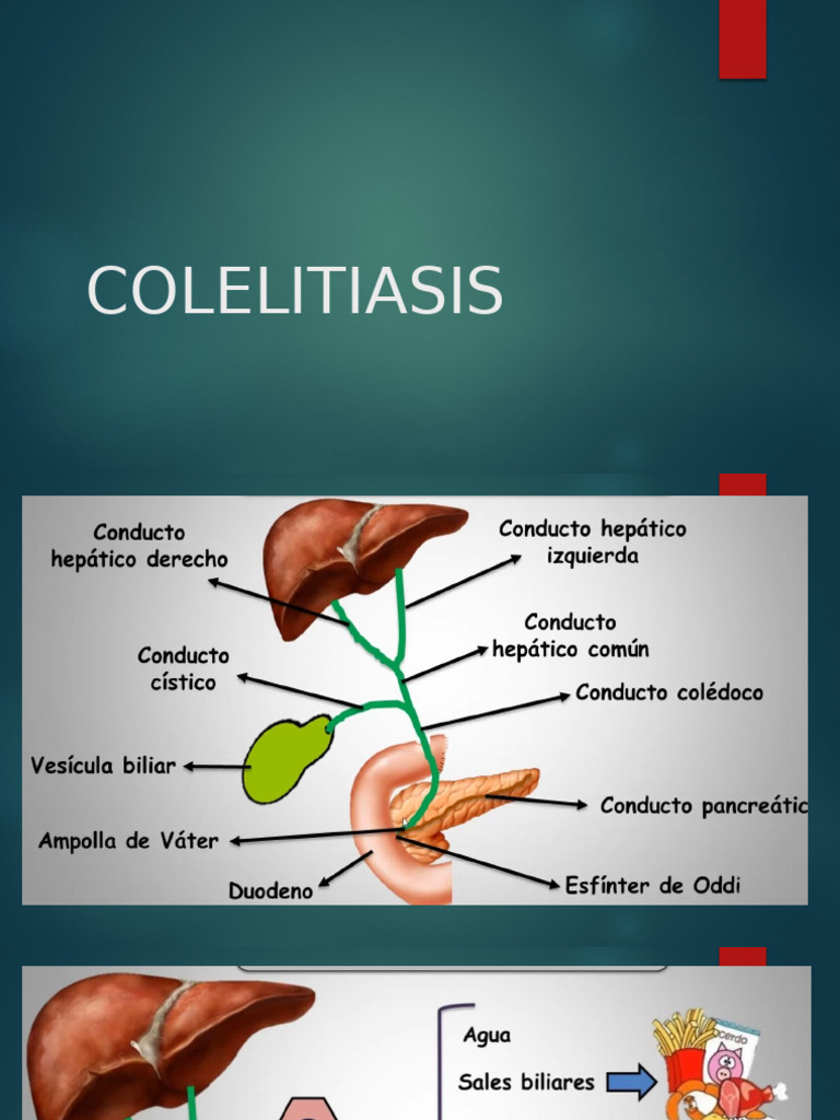 Colelitiasis Fisiopatologia | PDF