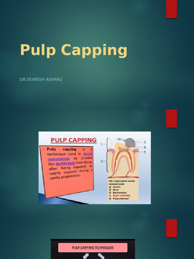Pulp Capping | PDF