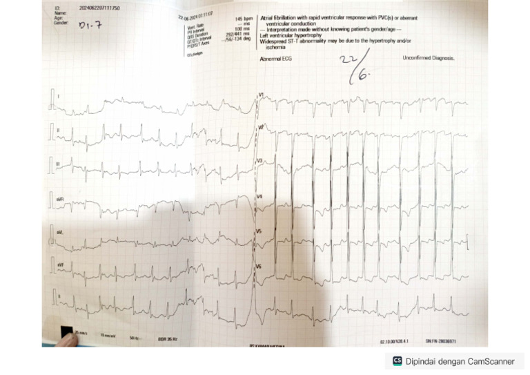 Ecg | PDF