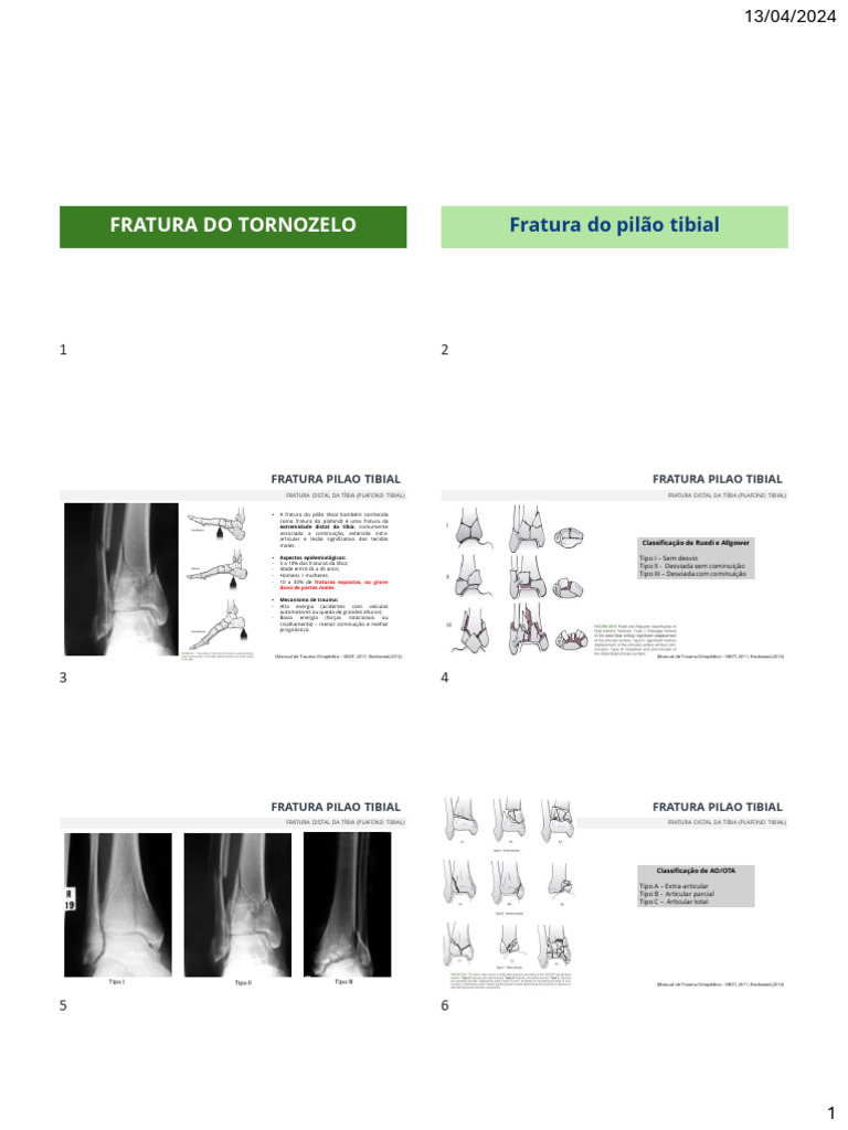 Fratura Do Tornozelo - Pilao Tibial Maleolar | PDF | Cirurgia ...