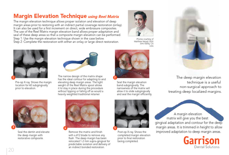 Deep Margin Elevation Technique Guide | PDF | Dentistry Branches