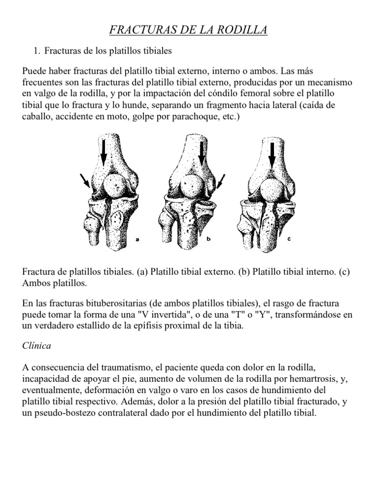 Fracturas de Platillos Tibiales | PDF | Rodilla | Sistema ...