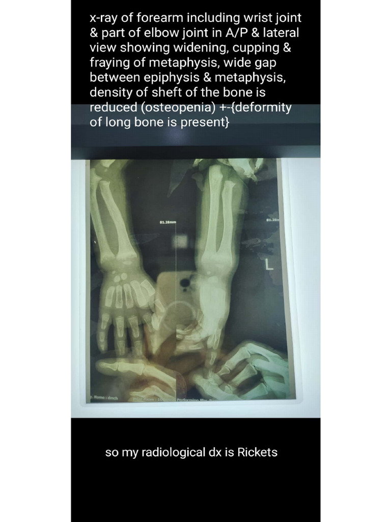 Pedi Block Final X-Ray | PDF