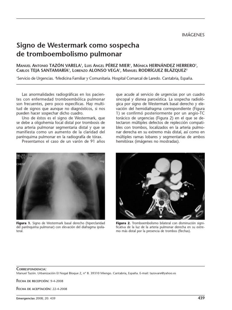 Tep Signo de Westermark | PDF