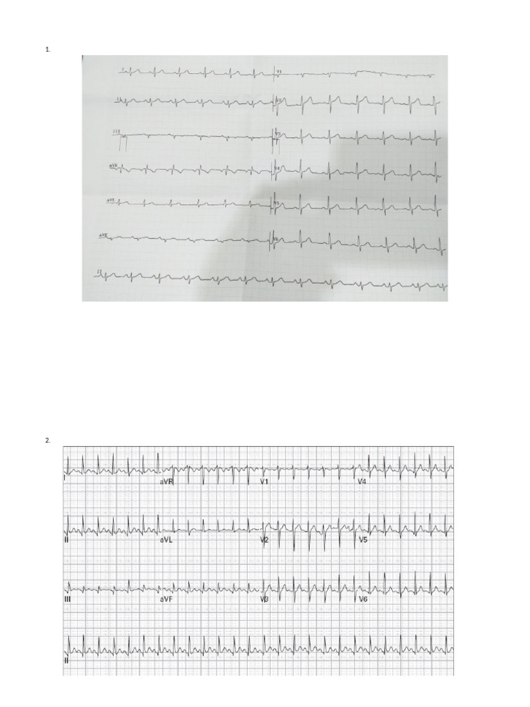 Soal EKG Normal 2024 | PDF