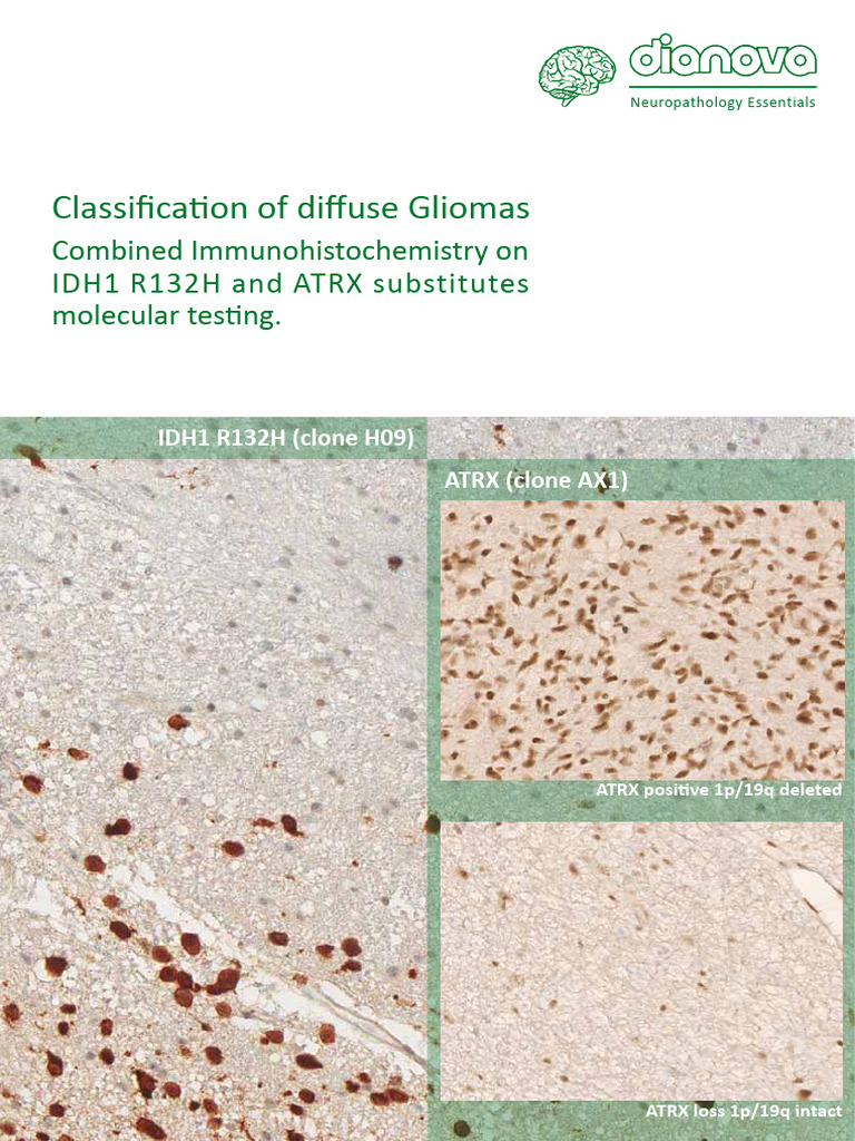Idh1r132h+atrx Glioma-Ihc Flyer | PDF | Glioma | Medical Specialties
