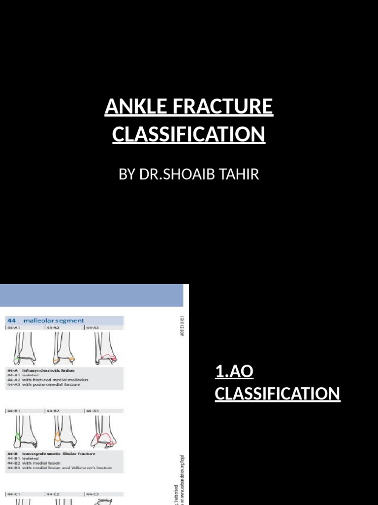 Ankle Fractures | PDF