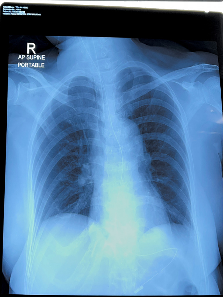 CXR Post Tube | PDF