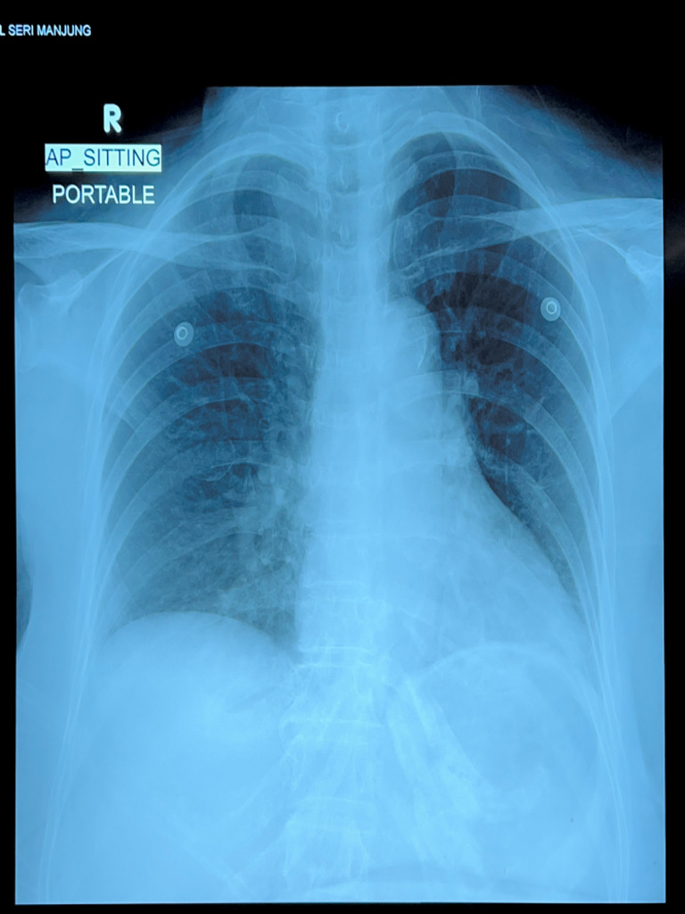 CXR Pre Intubation | PDF