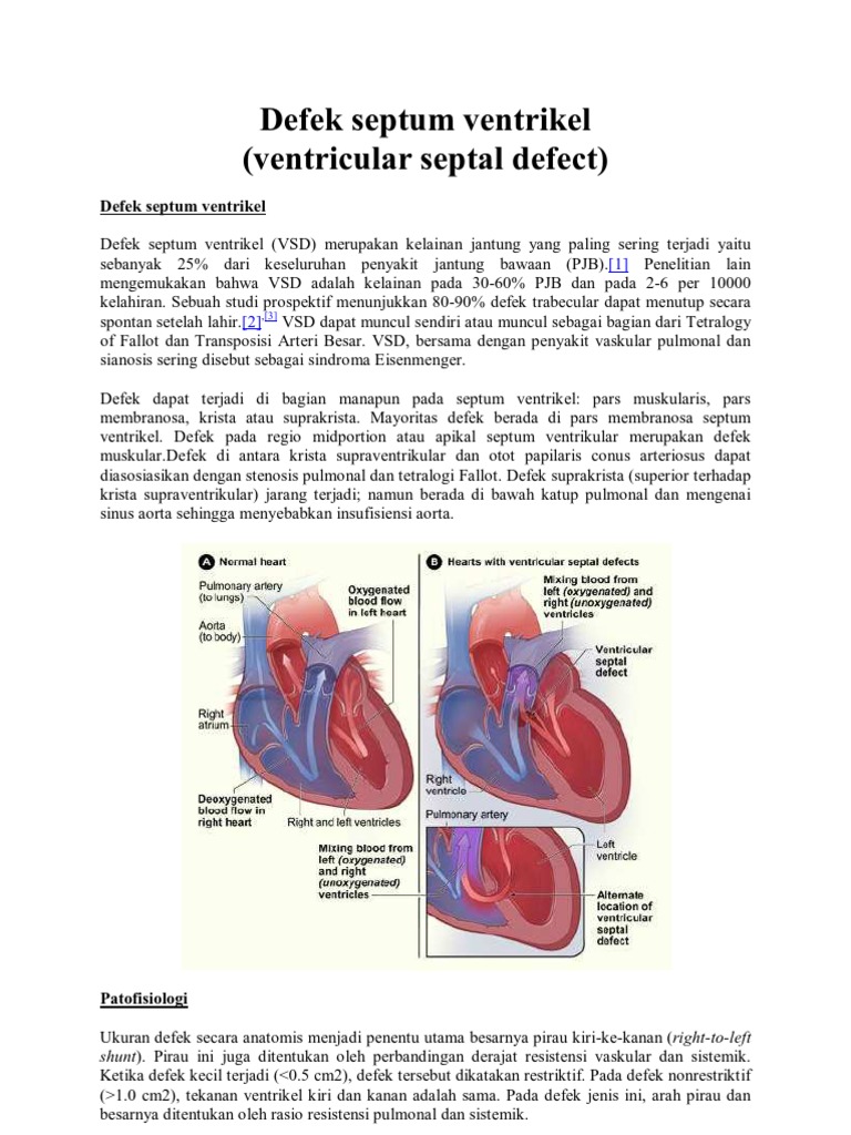 Defek Septum Ventrikel | PDF