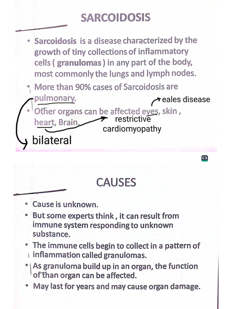 Sarcoidosis | PDF