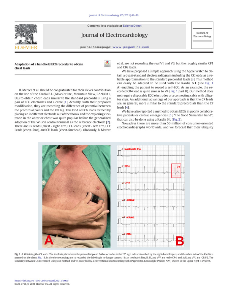 Adaptation of A Handheld ECG Recorder To Obtain Chest Leads (AliveCor ...