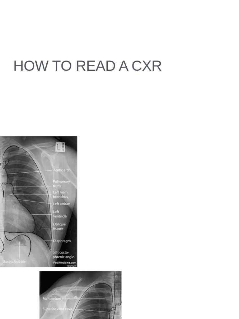 chest xray reading | PDF | Lung | Heart