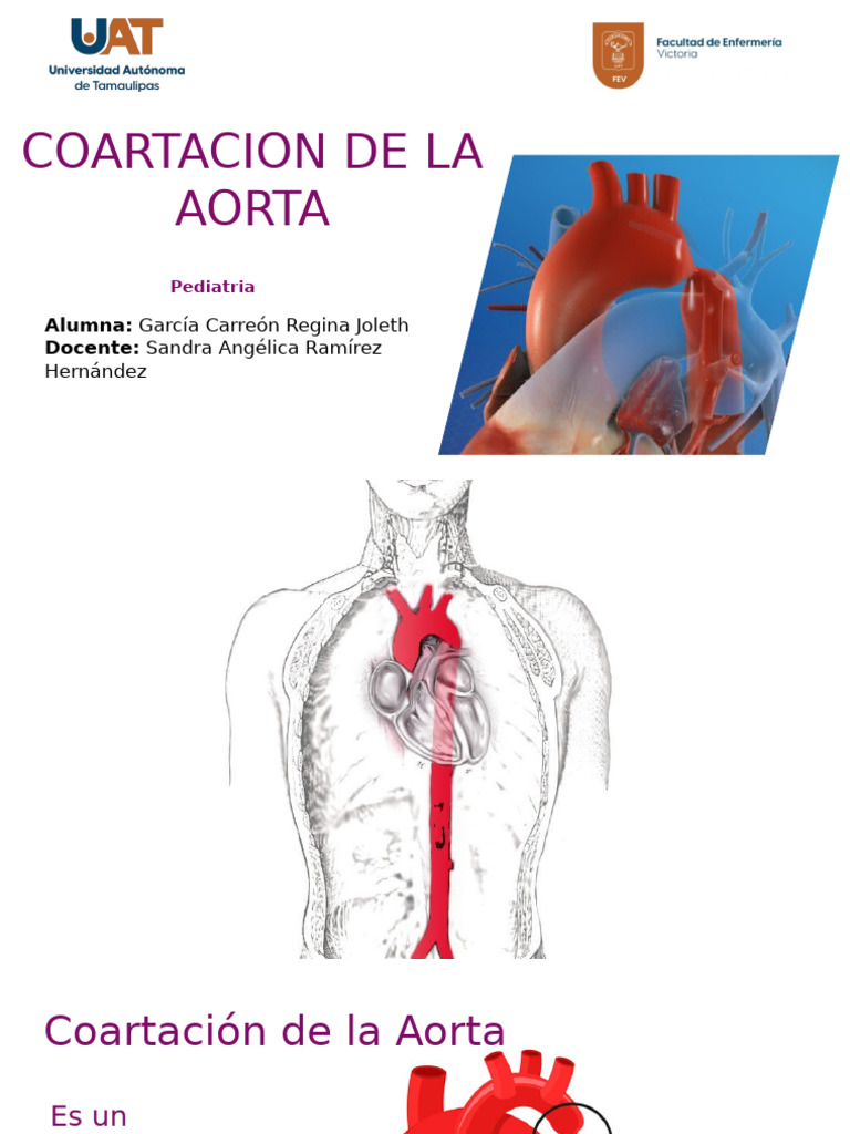 Coartación Aórtica: Tipos y Tratamiento | PDF