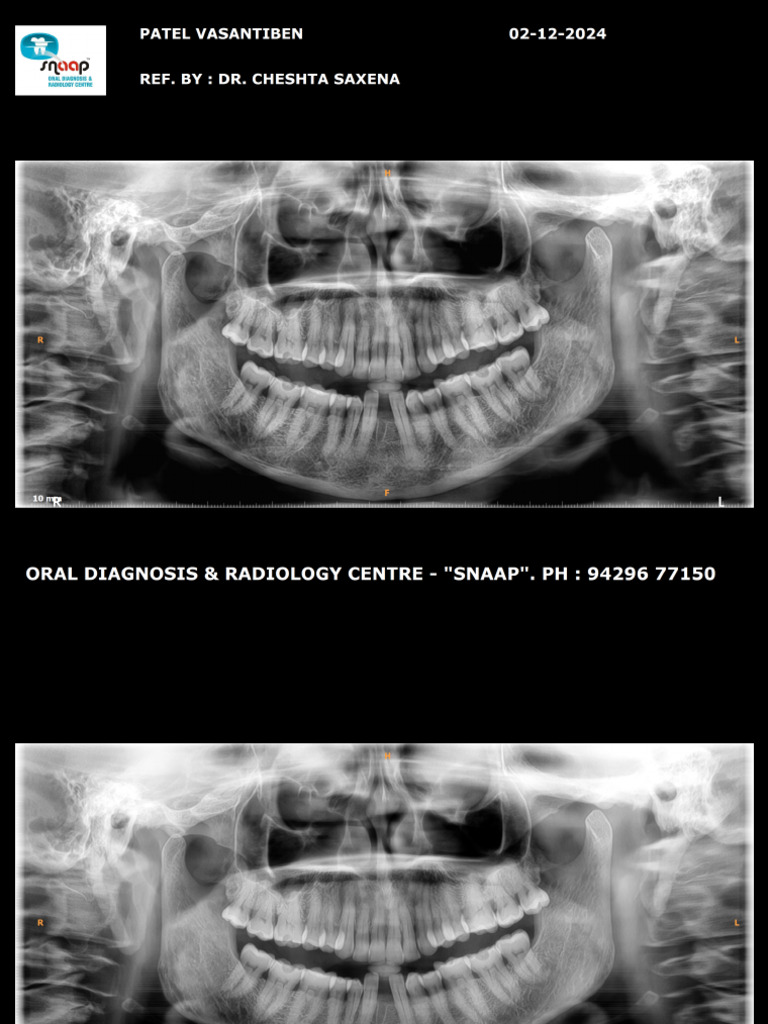 Vasantiben Patel Opg | PDF
