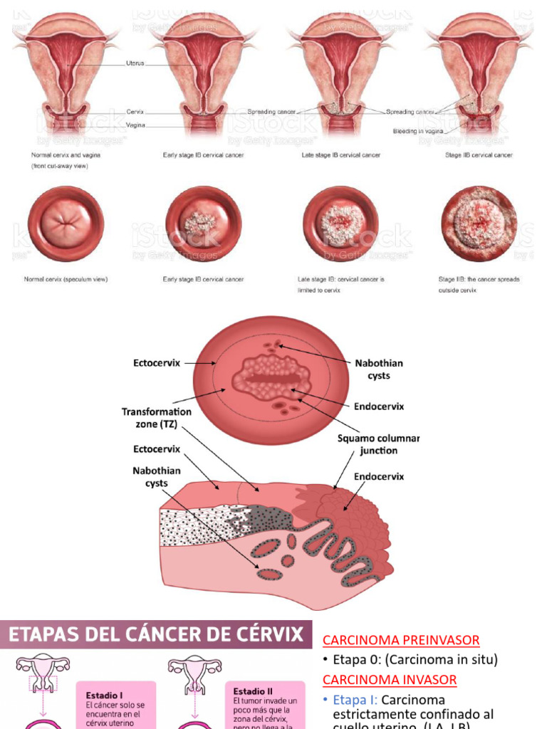 cancer-cervicouterino_udocz | PDF