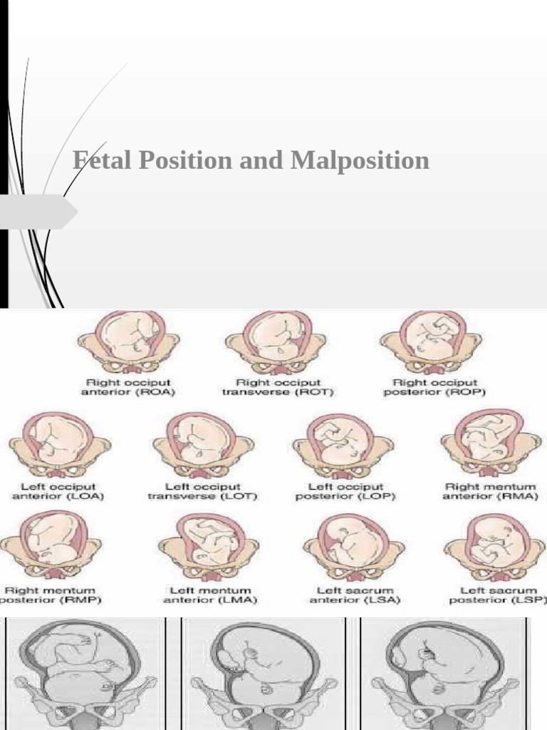 Managing Fetal Malpositions in Labor | PDF | Childbirth | Caesarean Section