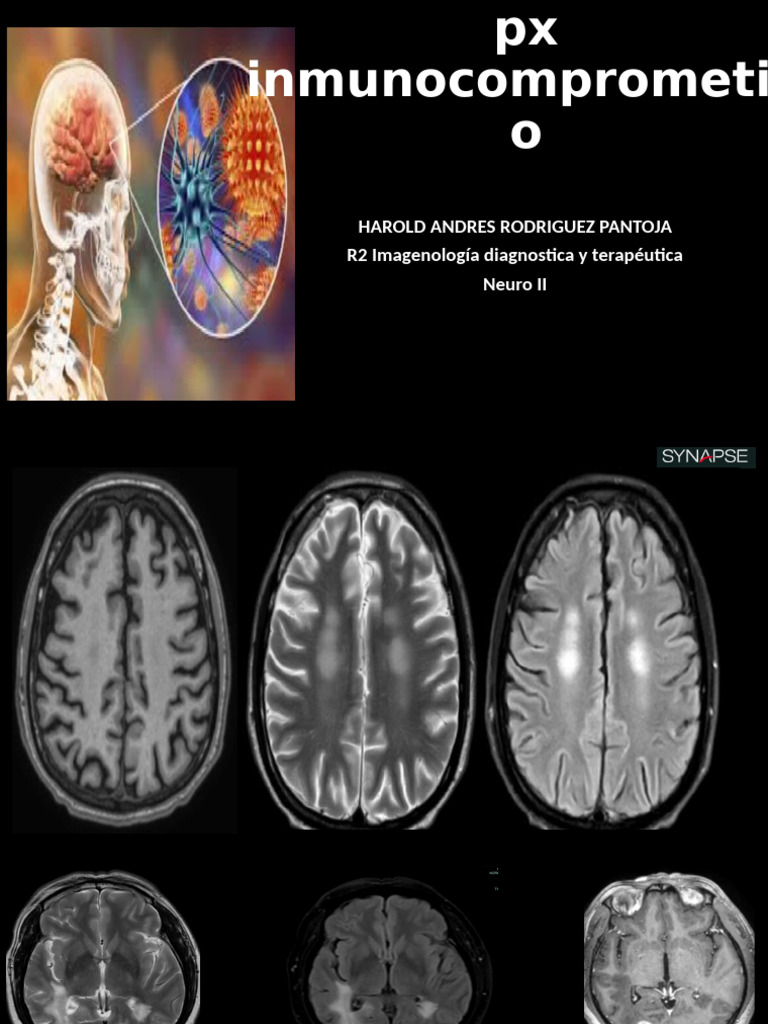 Infección del SNC en inmunocomprometidos | PDF | Epidemiología | Medicina