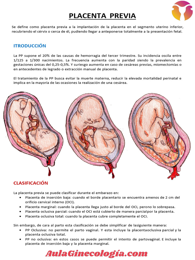 Manejo y Clasificación de Placenta Previa | PDF | El embarazo | Placenta