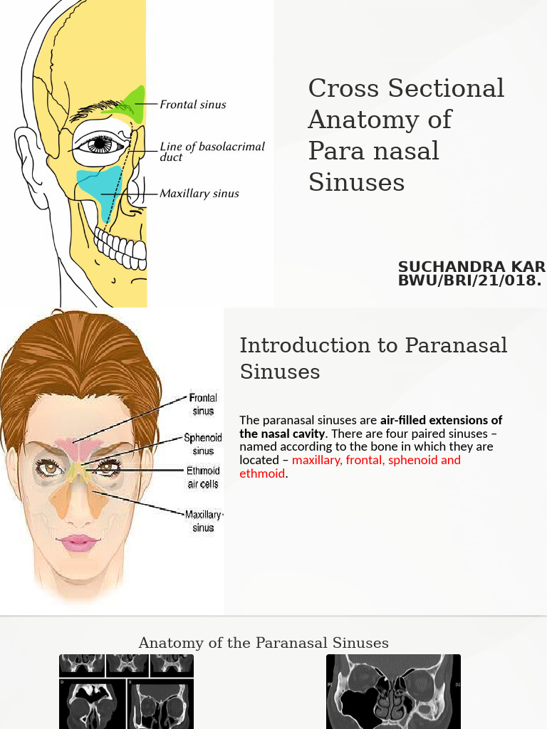 Cross-Sectional-Anatomy-of-Para-nasal-Sinuses PRESENTATION | PDF ...