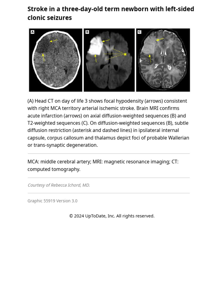 Stroke in a Three-day-old Term Newborn With Left-sided Clonic Seizures ...