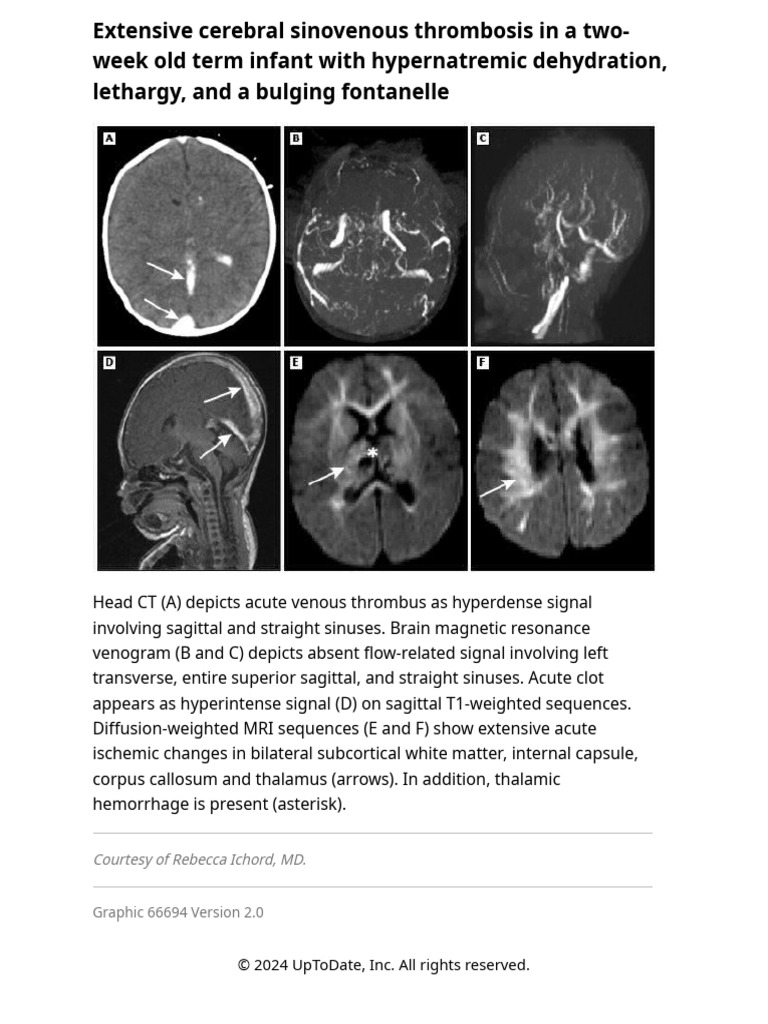 Extensive Cerebral Sinovenous Thrombosis in A Two-Week Old Term Infant ...